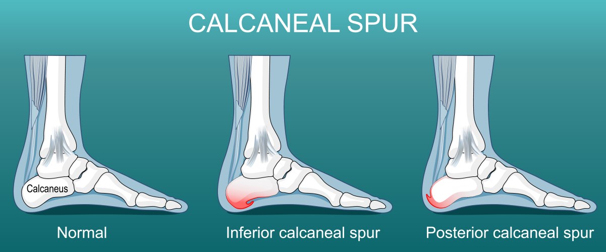 Calcaneal Spur Vector Images (60)