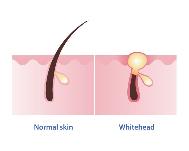 Normal skin and blackhead acne Royalty Free Vector Image