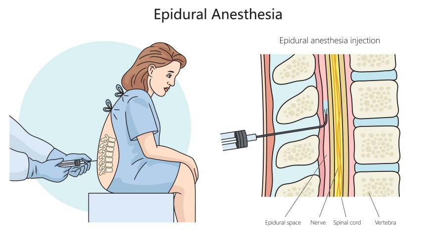 Epidural Vector Images (over 230)