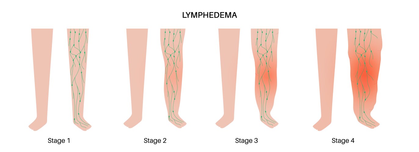 Stages of lymphedema Royalty Free Vector Image