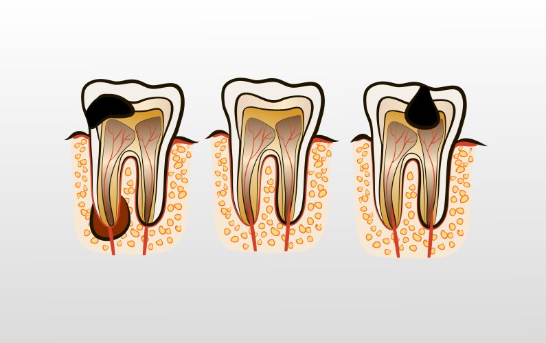 Tooth Decay - Superficial & Deep Caries Vector Image
