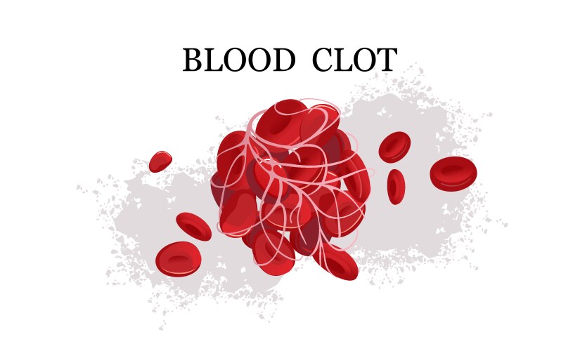 Blood vessel and clot thrombus Royalty Free Vector Image