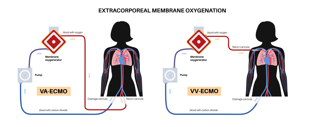 Extracorporeal membrane oxygenation Royalty Free Vector