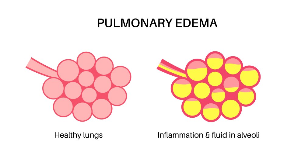 Pulmonary Edema Vector Images (38)