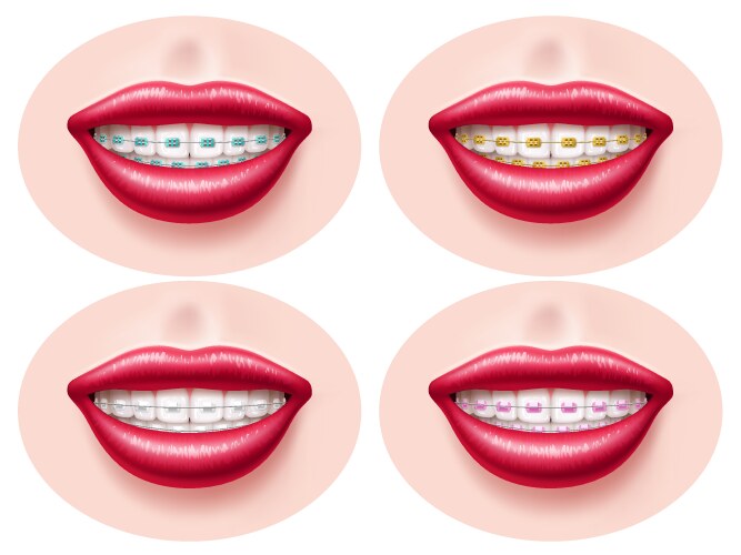 Teeth braces types realistic infographics Vector Image