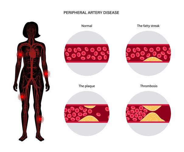 Peripheral Artery Disease (PAD) – Royalty-Free Vector | VectorStock