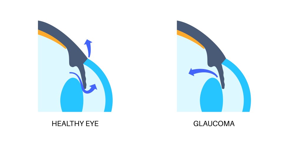 Glaucoma eye disease Royalty Free Vector Image