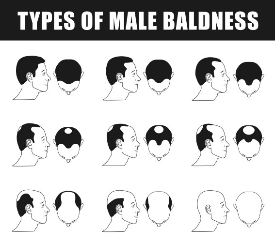Stages of male pattern baldness diagram medical Vector Image