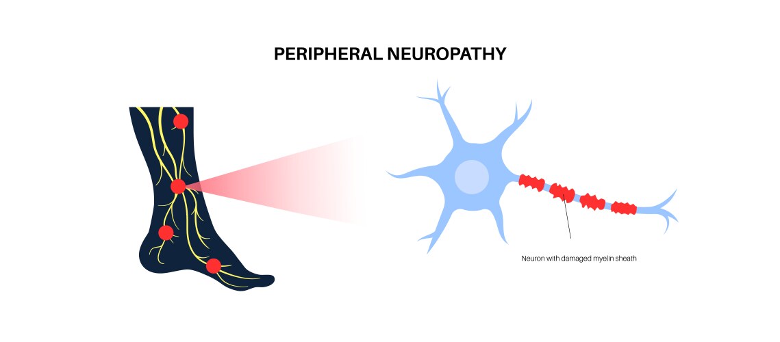 Peripheral neuropathy medical poster Royalty Free Vector
