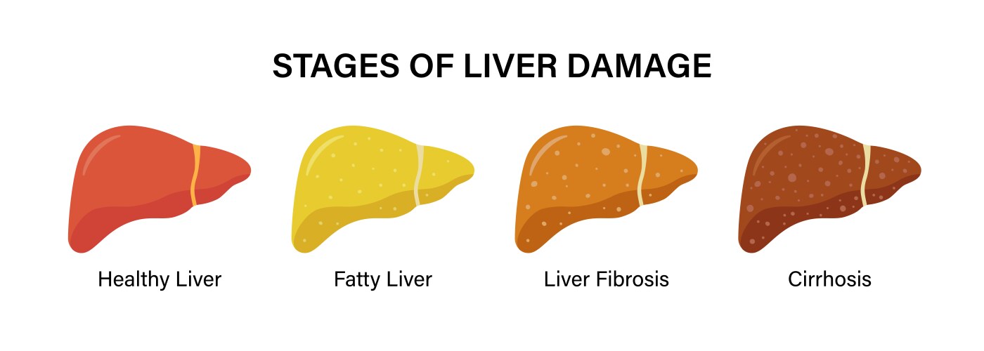 Stages nonalcoholic liver damage healthy Vector Image