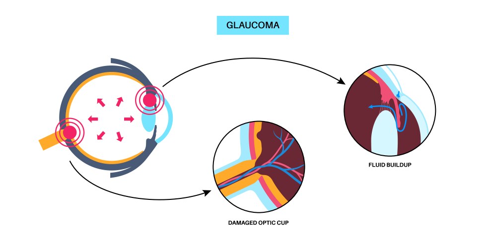 Glaucoma eye disease Royalty Free Vector Image
