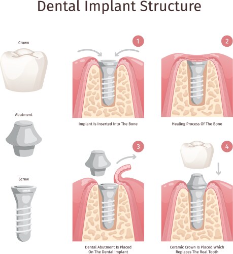 Implant Vector Images (over 26,000)