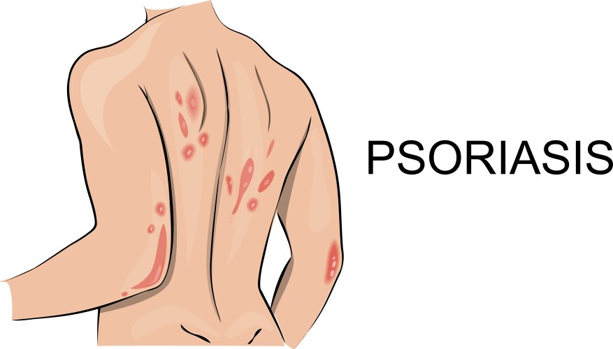 Red Rash Vector Images (over 2,800)