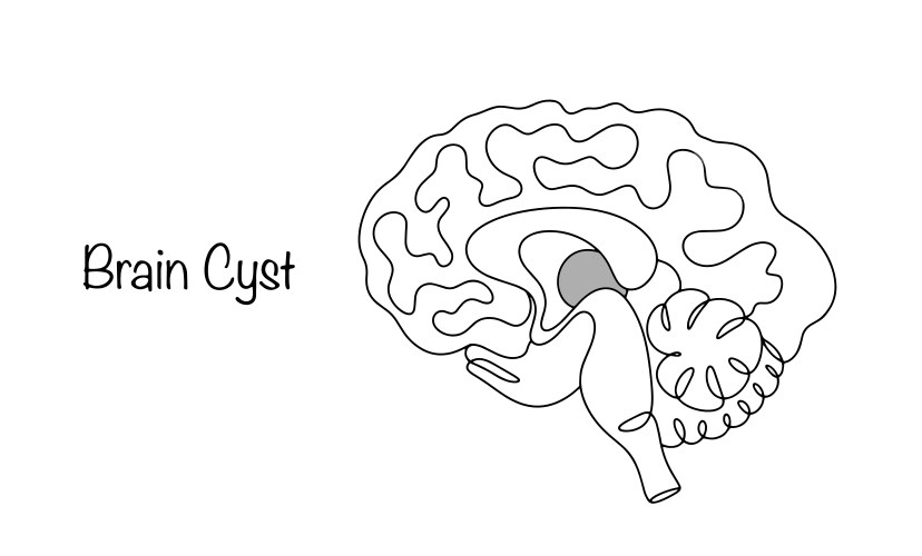 Meniscal cyst Royalty Free Vector Image - VectorStock