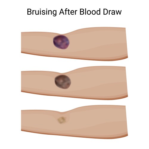 Hematoma Vector Images & Graphics for Commercial Use | VectorStock