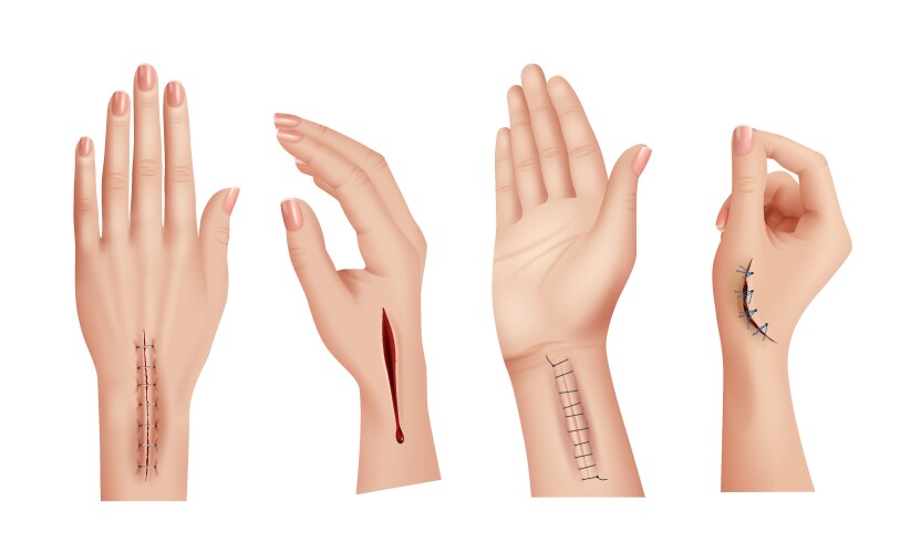 Realistic surgical stitches scars bruise Vector Image