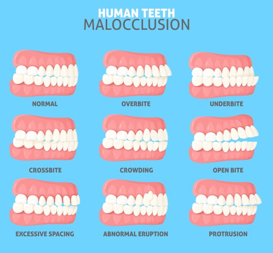 Malocclusion Vector Images Over 110