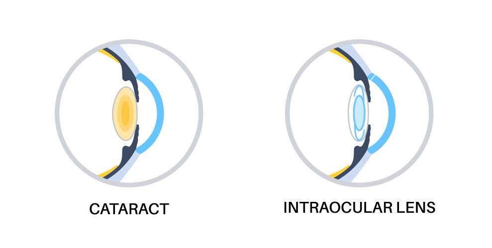 Intraocular lenses poster Royalty Free Vector Image