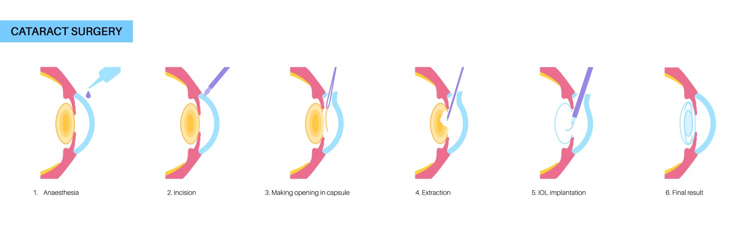Intraocular lenses poster Royalty Free Vector Image