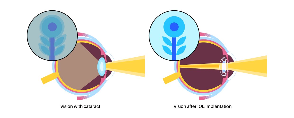 Intraocular lens poster Royalty Free Vector Image