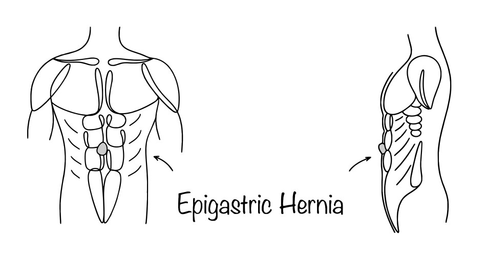 Hernia Vector Images (over 990)