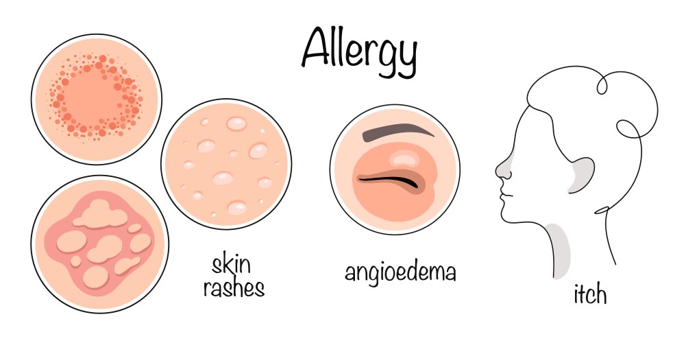 Allergy Reaction Vector Images (over 4,100)