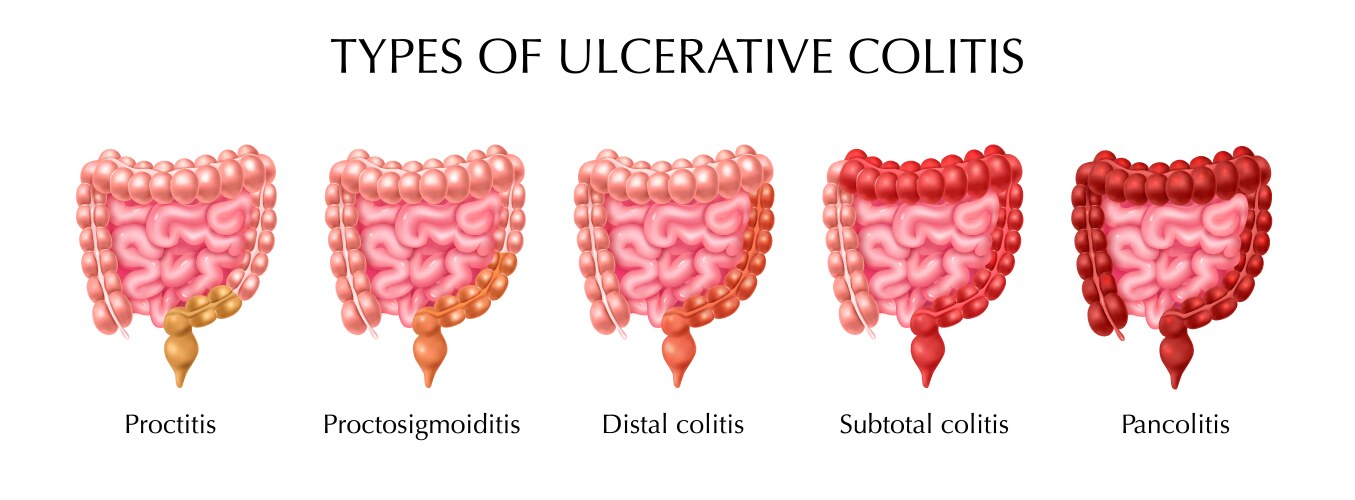 Ulcerative colitis types infographics Royalty Free Vector