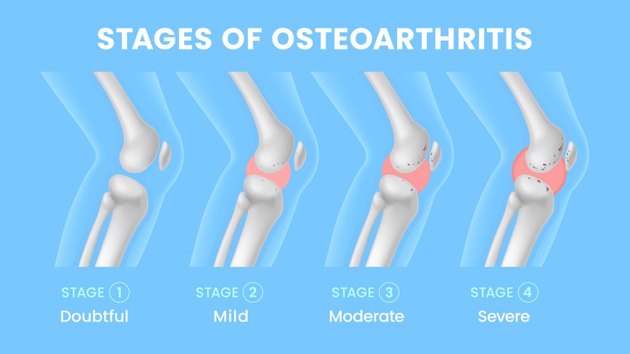 Knee Osteoarthritis Poster Royalty Free Vector Vectorstock