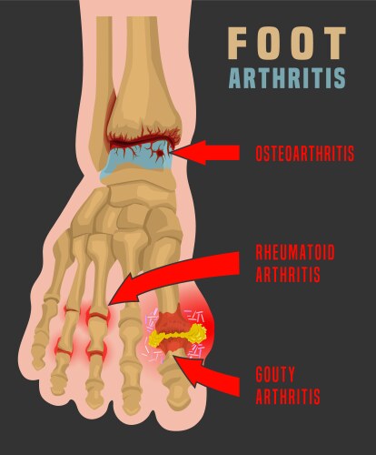Gout arthritis infographic Royalty Free Vector Image