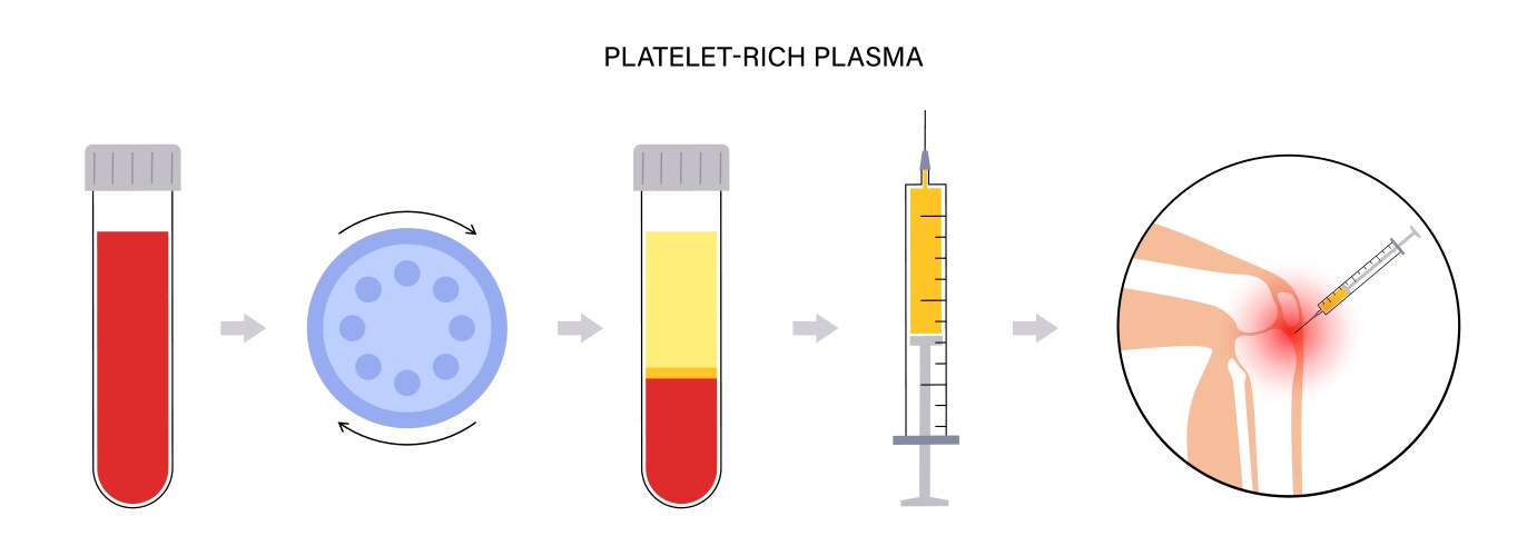 Platelet-rich plasma procedure knee joint Vector Image