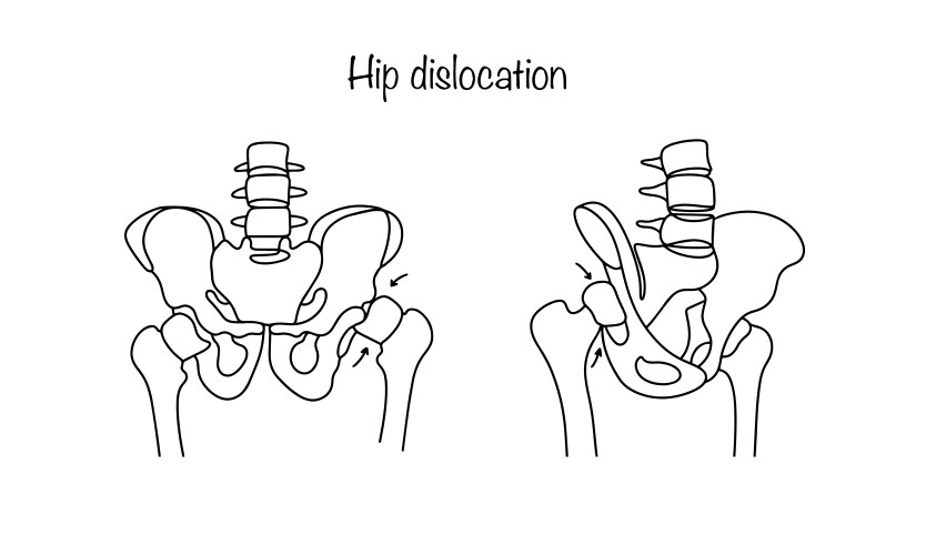 Hip Dislocation Vector Images (28)