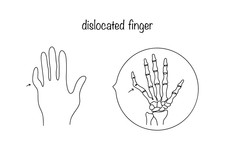 Dislocated wrist Royalty Free Vector Image - VectorStock