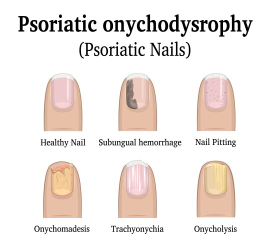 Nail Psoriasis Types & Symptoms – Royalty-Free Vector | VectorStock