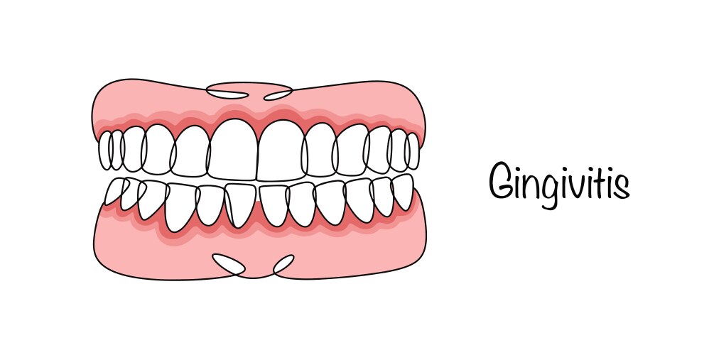 Gingivitis Vector Images (over 1,200)