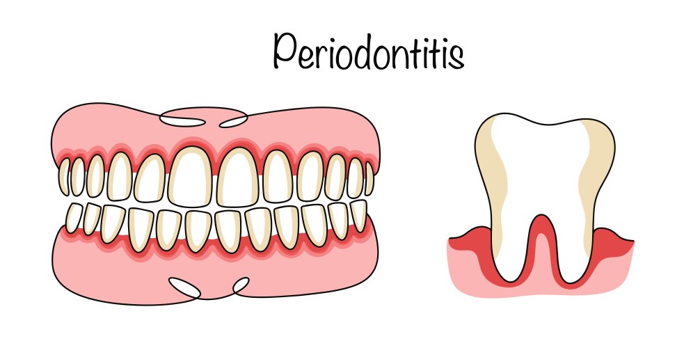 Periodontal Vector Images (over 1,700)