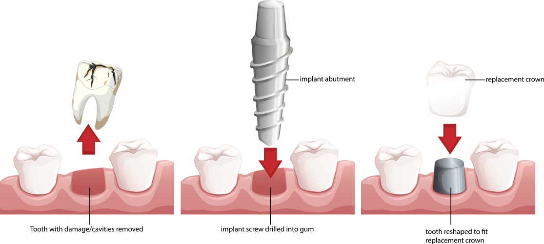 Step-by-step guide to dental implant process Vector Image
