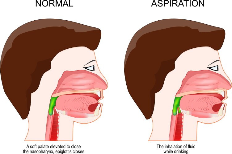 Dysphagia aspiration food or liquid into the lungs