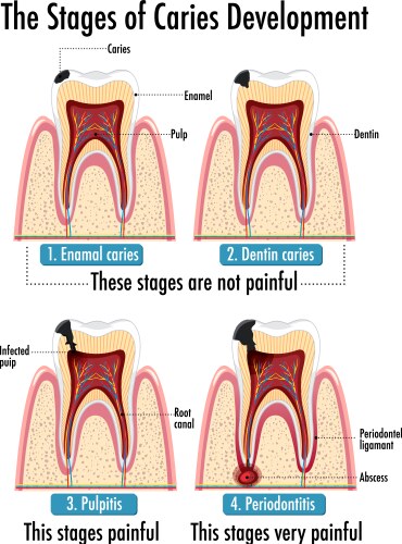 Infographic of human in stages caries Royalty Free Vector