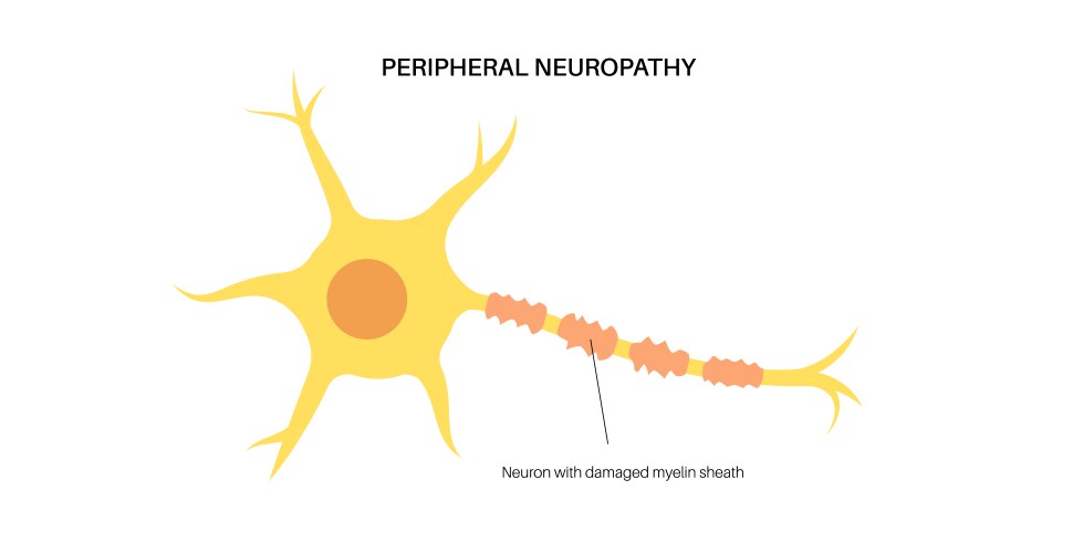 Peripheral neuropathy medical poster Royalty Free Vector