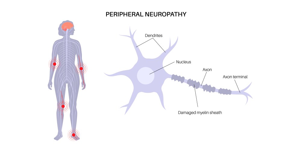 Peripheral neuropathy medical poster Royalty Free Vector