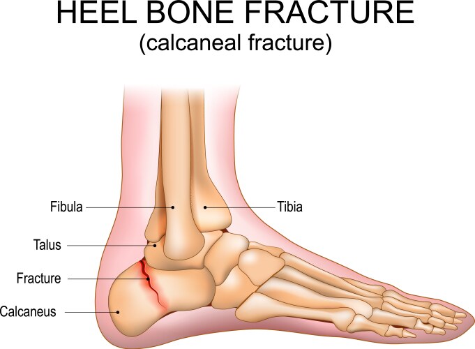 Calcaneal fracture trauma of heel bone Royalty Free Vector