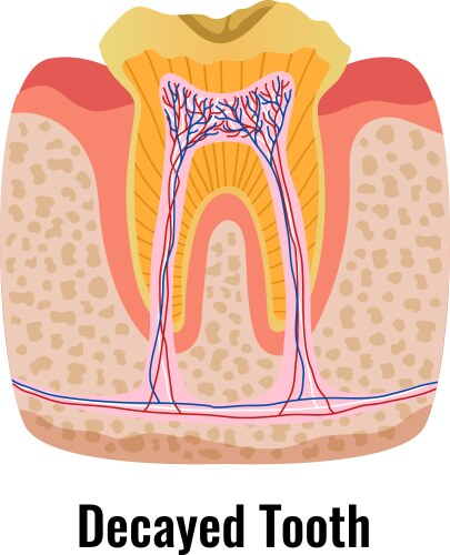 Dental disease poster Royalty Free Vector Image