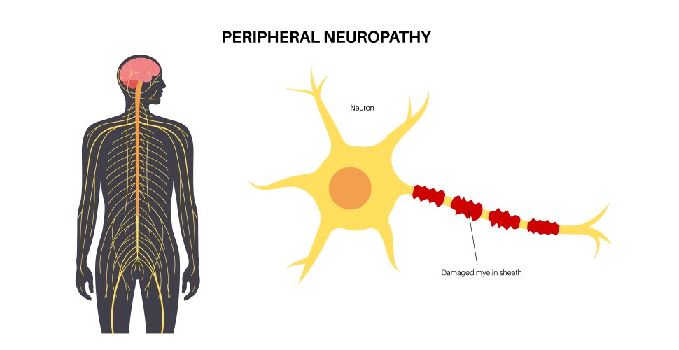 Peripheral neuropathy medical poster Royalty Free Vector