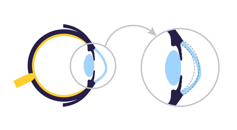 Cataract Eye Disease Royalty Free Vector Image