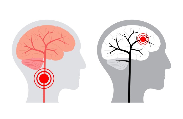 Abstract human brain injury stroke cartoon Vector Image