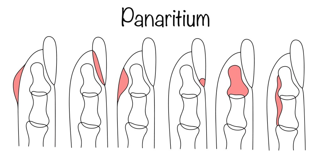 Staphylococcus Vector Images (over 1,800)