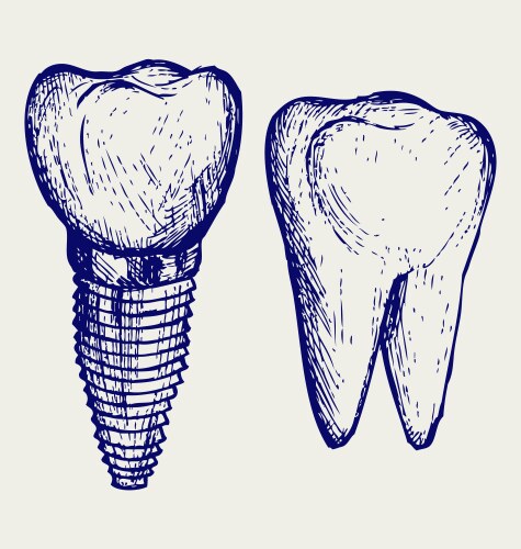 Implant Vector Images (over 26,000)
