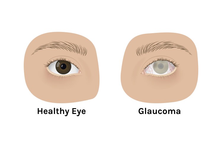 Realistic human normal eyes and with colomba Vector Image