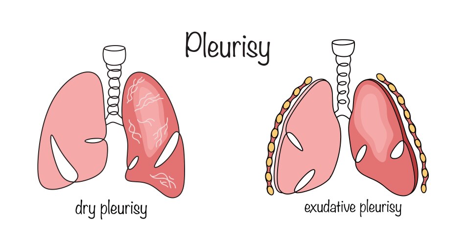 Lung Fibrosis Vector Images (over 500)