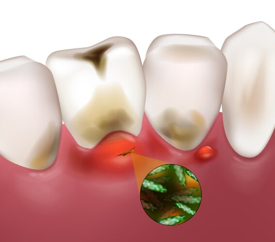 Gingivitis Vector Images (over 1,200)